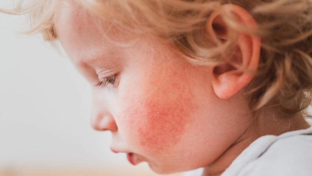 Baby Red Cheeks: What to Know | Peanut