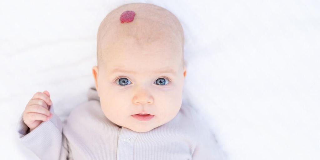 What is a Hemangioma? Causes, Types & Treatment | Peanut