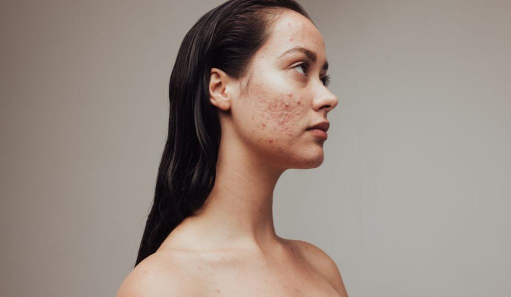Pregnancy Acne: Causes, Cures & What to Do | Peanut